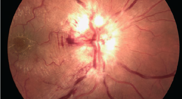 FDA Approves Implant to Treat Diabetic Macular Edema | Consultant360